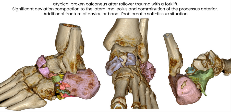 Calcaneal fracture atypical - Minimal invasive treatment of calcaneal ...