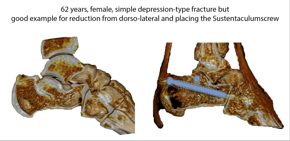 calcaneal fracture, - Minimal invasive treatment of calcaneal fractures