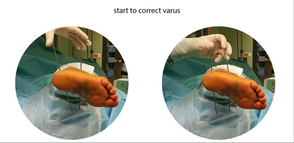 calcaneal fracture, - Minimal invasive treatment of calcaneal fractures