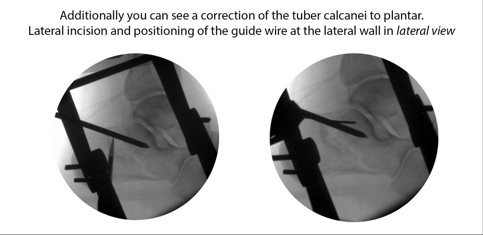 calcaneal fracture, - Minimal invasive treatment of calcaneal fractures