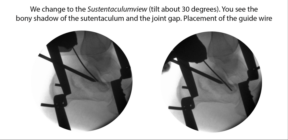 calcaneal fracture, - Minimal invasive treatment of calcaneal fractures