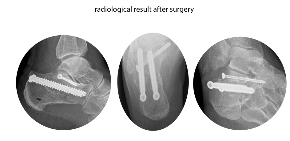 calcaneal fracture, - Minimal invasive treatment of calcaneal fractures